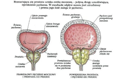 Prostata: objawy, zapobieganie i profilaktyka - UrodaiZdrowie.pl portal ...